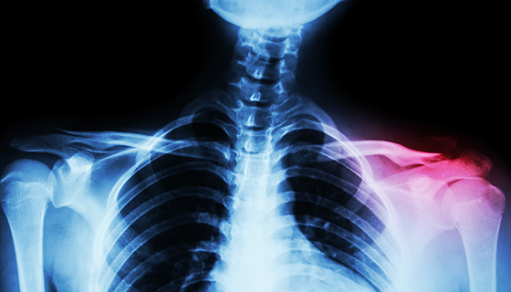 How Do Bones Heal Glossop Physio
